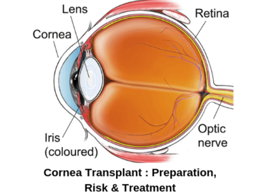 Cornea Transplant : Preparation, Risk & Treatment | EyeMantra