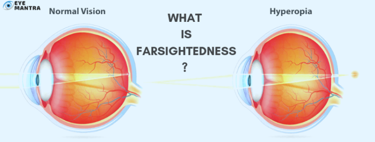 Farsightedness | Hyperopia: Symptoms, Causes &Treatment | Eyemantra